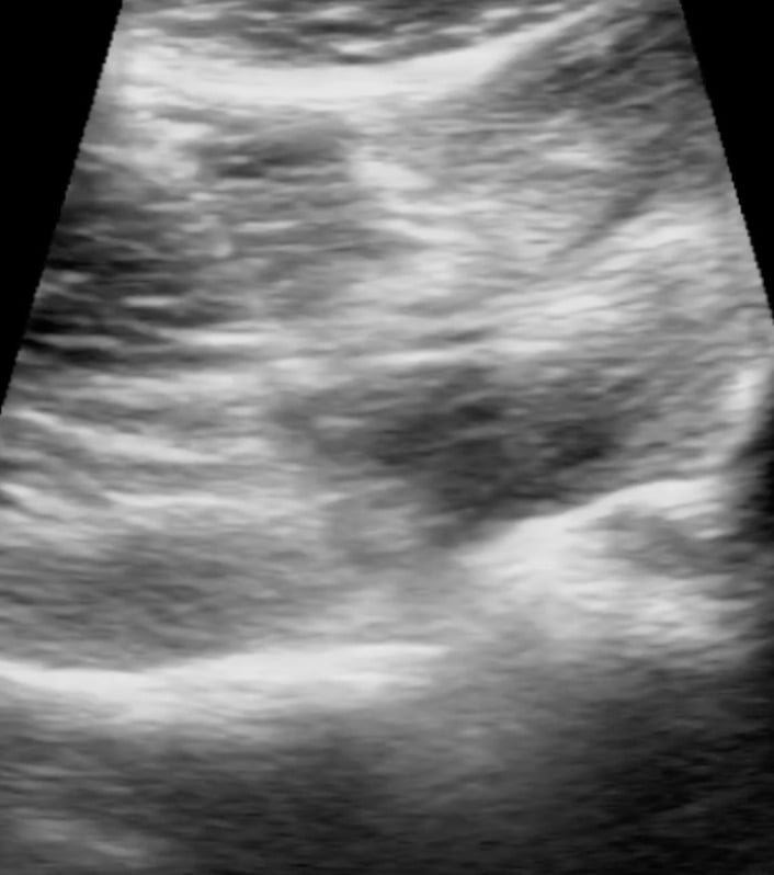 How I'm Healing My Hip Labral Tear Without Surgery - The Mother Runners